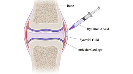 Analytical solutions for hyaluronic acid flow and heat transfer between ...