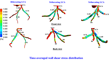 Hemodynamics in left coronary artery with ramus intermedius: A patient ...