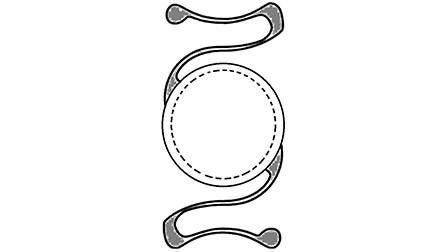 Aqueous flow in the anterior chamber with angle-supported intraocular ...