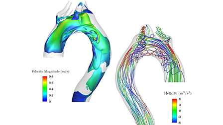 Helical vortex arising from aberrant right subclavian artery induces ...