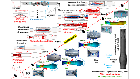 Pulsatile flow dynamics in an artery with multiple pathologies: A fluid–structure interaction ...