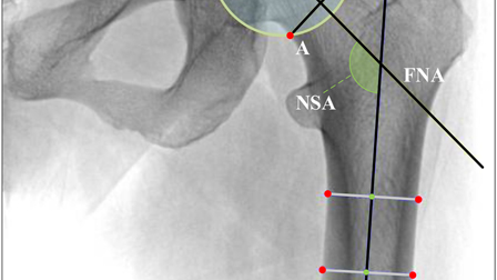 An approach for fully automatic femoral neck-shaft angle evaluation on ...