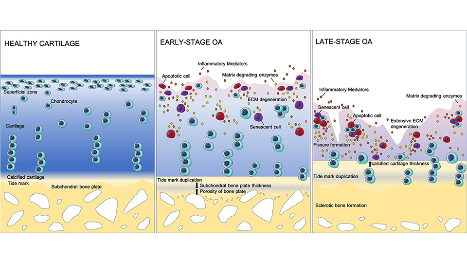 Accounting for mechanobiology to model and treat osteoarthritis ...