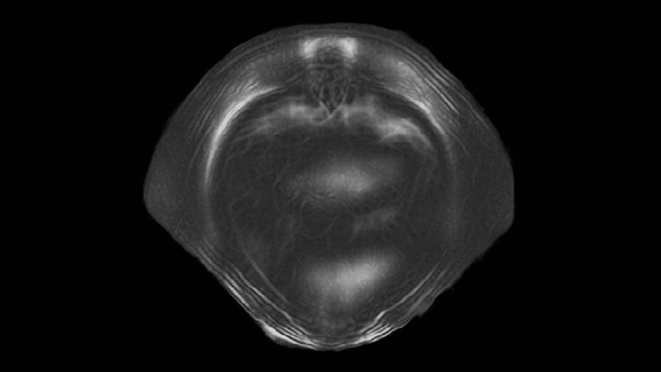 Microwave-induced ultrasound imaging offers high-resolution, real-time tissue monitoring ...